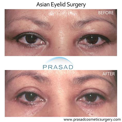 Double Eyelid Surgery Before And After Photos Dr Amiya Prasad