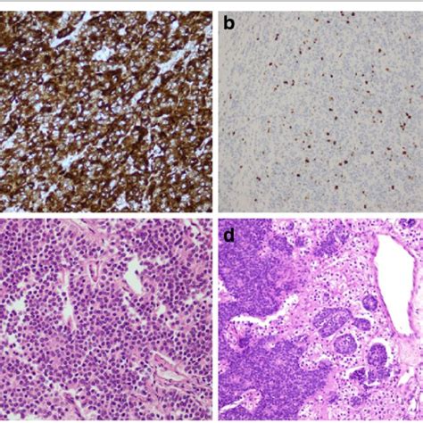 Technetium 99m Sestamibi Parathyroid Scan The Scan Shows Focal Area Of