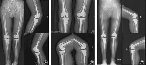 Knee Reconstruction Using 3d‐printed Porous Tantalum Augment In The