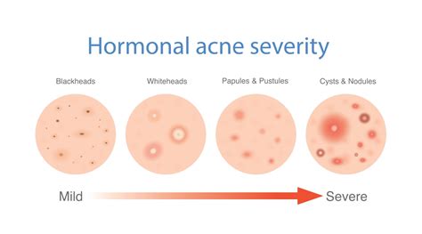 Hormonal Acne Chin