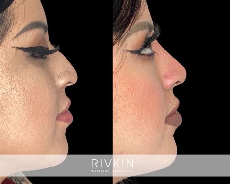 Hispanic Nose Rivkin Aesthetics