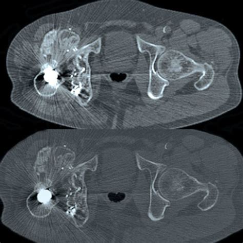 A Amorphous High Density Sites Can Be Observed On Rectus Femoris Download Scientific Diagram