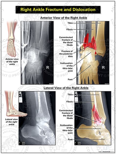 Tibiotalar Joint Dislocation
