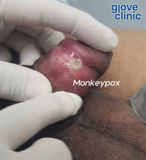 Monkeypox Symptoms And Treatment GLOVE CLINIC
