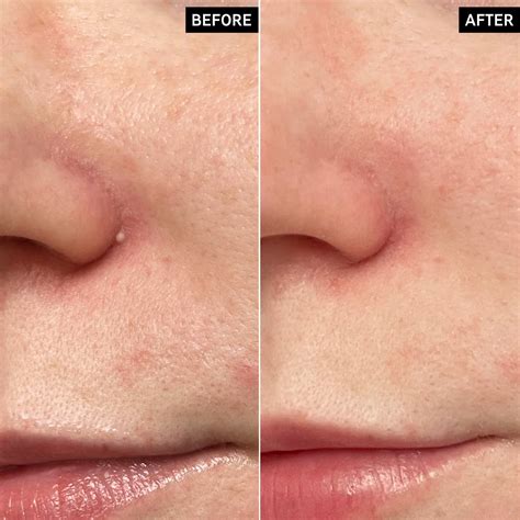 Hydrocolloid Spot And Pimple Patch The Inkey List