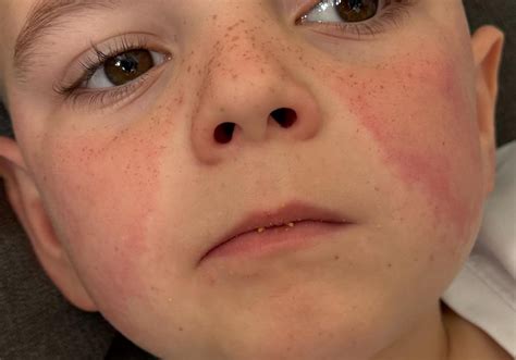 7 Year Old Lad Woke Up This Rash R Dermatologyquestions