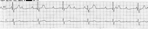 File Rhythm Strip Showing Third Degree Heart Block  Wikem