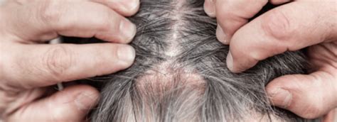 Hoofdhuid Psoriasis Oorzaak En Tips Sproet