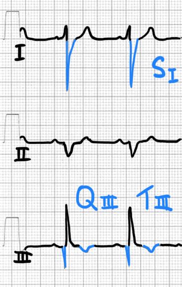 Pulmonary Embolism Pe
