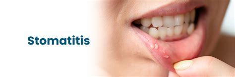 Stomatitis Lips