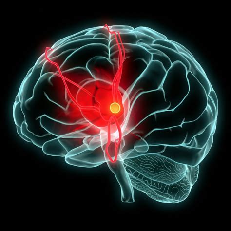 Transient Ischemic Attack Tia Causes Symptoms Treatment Options And Prevention