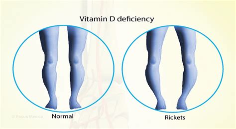 Rickets Disease Causes Symptoms Diagnosis Treatment And Prevention