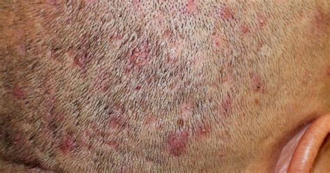 Scalp Scabs And Sores Clearing Up Causes Care