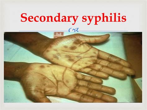 Ppt Syphilis Powerpoint Presentation Free Download Id 123585