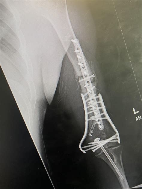 Left Humerus Before And 15 Yrs Later Rradiology