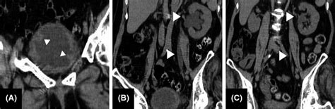 Abdominal Ct Images Taken At Admission Showed Trabeculated Bladder A Download Scientific