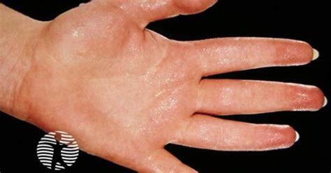 Hyperhidrosis Image