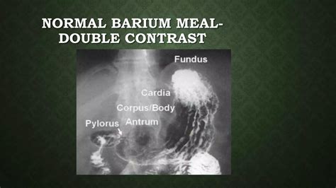 Barium Meal Pptx