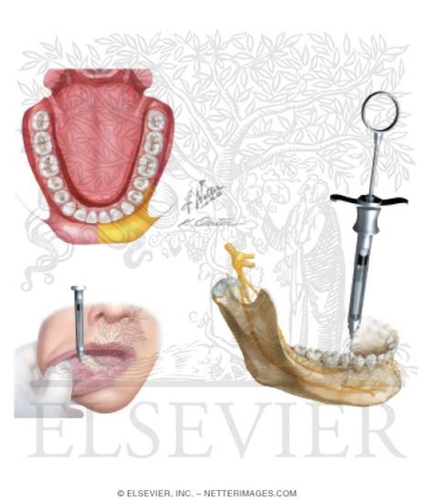 Mental Nerve Block Technique