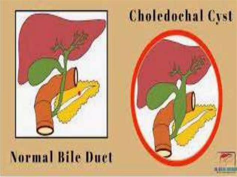 Choledochal Cystpptx