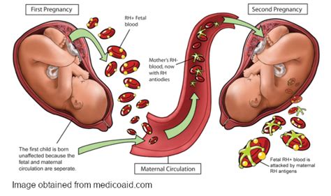 Hemolytic Disease Of The Fetus And Newborn Hdfn Med Lab Study Hall