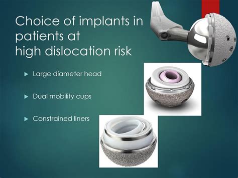 Bearing Surface Choice In Patients At High Risk For Dislocation Ppt Download