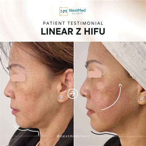Discover The Ultimate Non Surgical Facelift Hifu Treatment Nextmed