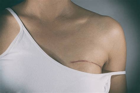 Does Breast Tissue Grow Back After Lumpectomy