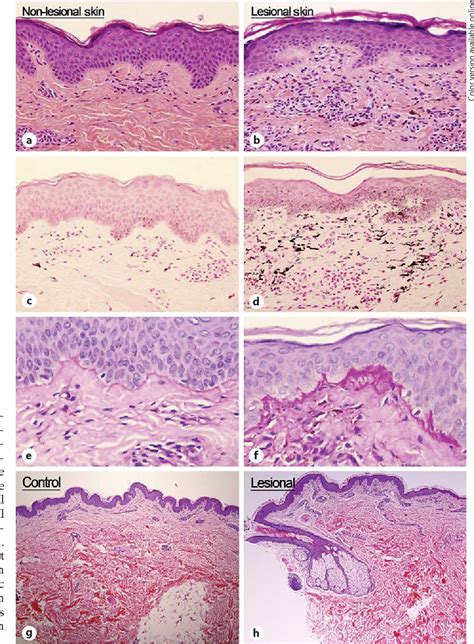 Figure 3 From Atopic Dirty Neck Or Acquired Atopic Hyperpigmentation An Epidemiological And
