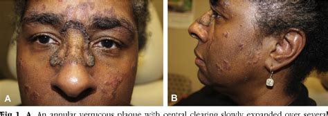 Sarcoidosis Skin African American