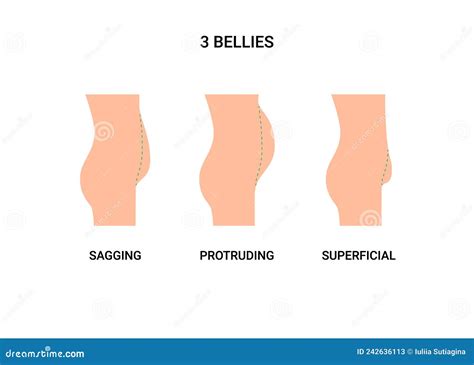 Types Of Bellies With Abdominal Fat Problem In Stomach Area Outline