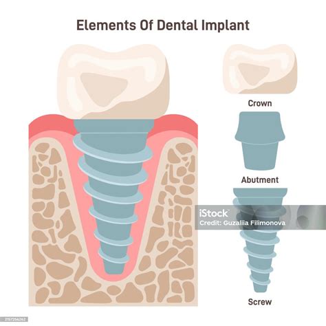 치과 임플란트 구조 인공 치아 부품 임플란트 크라운 어버트먼트 건강관리와 의술에 대한 스톡 벡터 아트 및 기타 이미지 건강