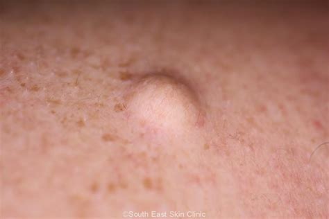 Sebaceous Cyst South East Skin Clinic