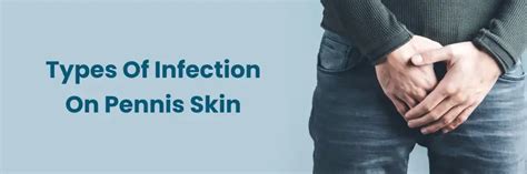 Types Dinfections De La Peau Du Pénis Guide Complet