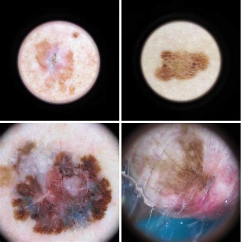 Skin Lesion Dataset Using Segmentation Kaggle