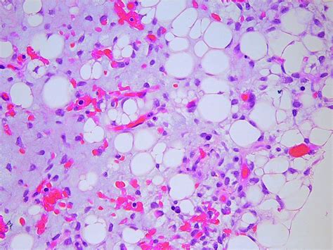 Liposarcoma Pathology Orthobullets