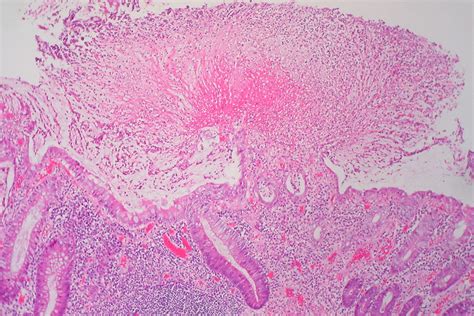 Pseudomembranous Colitis