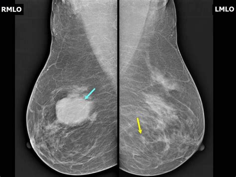 Atlas Of Breast Cancer Early Detection