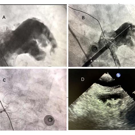 Pdf Effect Of Left Atrial Appendage Closure In Combination With