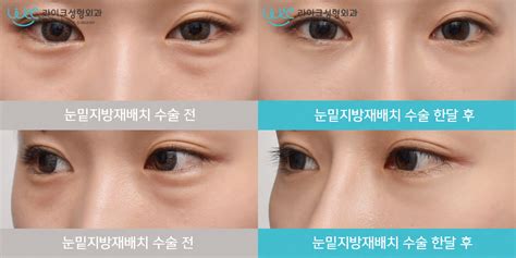 라이크성형외과팽팽 눈밑지방재배치