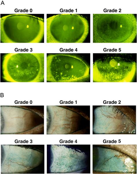 A The Final Corneal Grading Scale B The Final Conjunctival Grading Download Scientific