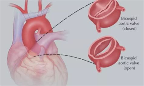 Atorvastatin Fails To Slow Aortic Dilatation And Valvular Calcification Progression In Bicuspid