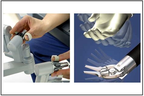 Robotic Vs Laparoscopic Hernia Surgery Differences Best Options