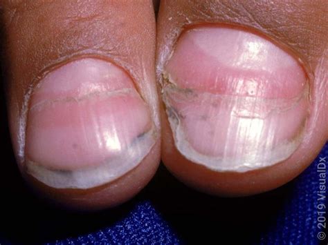 Beau S Lines Ridges In Fingernails Causes And Treatments Riverchase