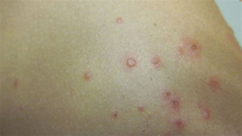 30 Facts About Congenital Varicella