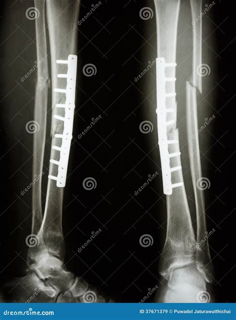 Fracture Shaft Of Tibia And Fibula Stock Image Image Of Human Fracture