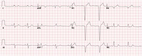 Left Bundle Branch Block Ecg Guru Instructor Resources 52 Off