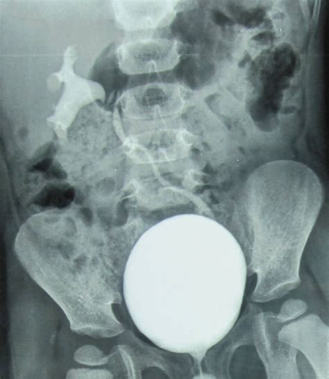 Voiding Cystoureterogram Shows Reflux Into The Solitary Crossed Ectopic Download Scientific