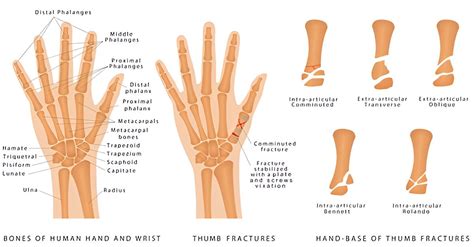 Understanding Hand Fractures Types Symptoms And Treatment Options