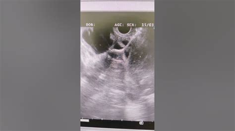 Eus Guided Gastrojejunostomy Youtube